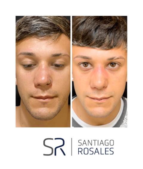 ¿Qué precio tiene una Rinoplastia en Argentina 2024/2025?