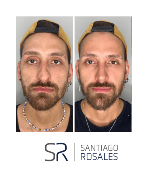 ¿Qué precio tiene una Rinoplastia en Argentina 2024/2025?