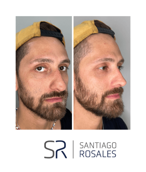 ¿Qué precio tiene una Rinoplastia en Argentina 2024/2025?